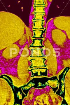 VERTEBRAL OSTEOARTHRITIS, CT-SCAN Vertebral osteoarthritis with ...