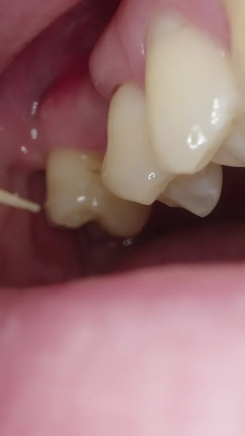 Video On Remov Stock Videos – Royalty-Free HD & 4K Videos | Pond5