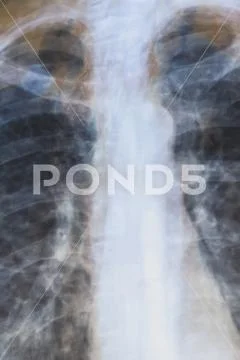 Vertical X-ray scan of Human bones disease. Spine cancer. Doctor learn ...