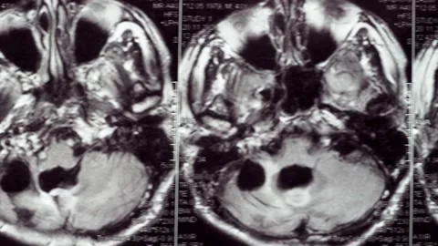 Viewing an MRI image showing a defect in... | Stock Video | Pond5