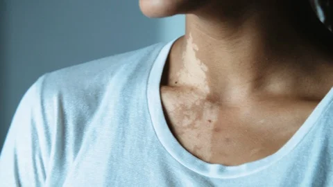 Vitiligo Skin Condition on Female of Mix... | Stock Video | Pond5