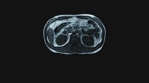 Voluminous color CT scan of the abdomen.... | Stock Video | Pond5