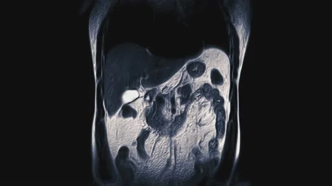Voluminous color CT scan of the abdomen.... | Stock Video | Pond5