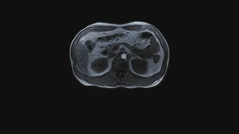 Voluminous color CT scan of the abdomen.... | Stock Video | Pond5