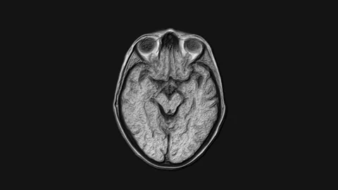 Voluminous MRI brain, head scans and tum... | Stock Video | Pond5