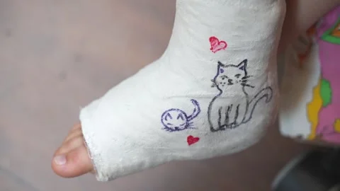 White plaster leg cast with hand-drawn c... | Stock Video | Pond5
