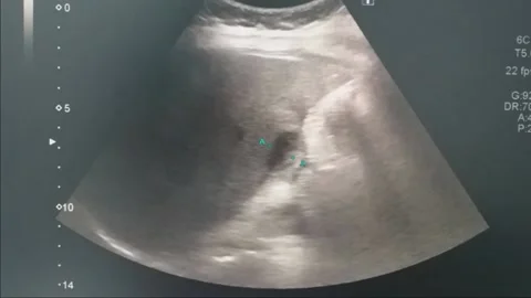 Whole abdomen ultrasound wave scan show ... | Stock Video | Pond5
