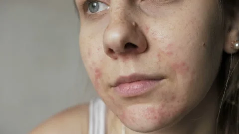 Dermatitis Woman Stock Footage ~ Royalty Free Stock Videos | Pond5