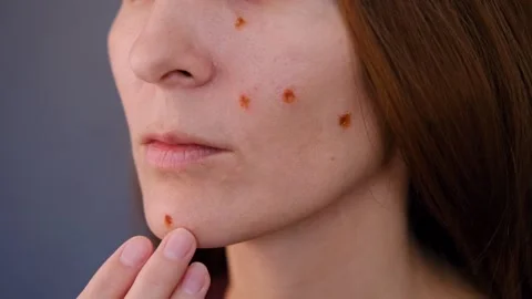 Woman with burns on her face after remov... | Stock Video | Pond5