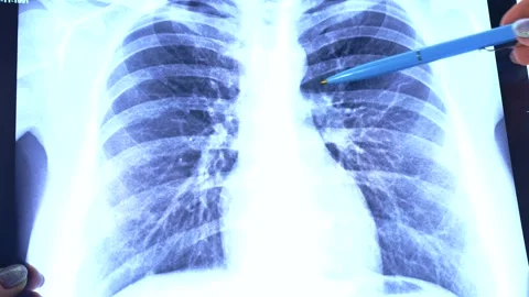 Chest X Ray Stock Footage ~ Royalty Free Stock Videos | Pond5