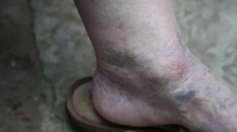 Woman leg with thrombosis, skin problem,... | Stock Video | Pond5