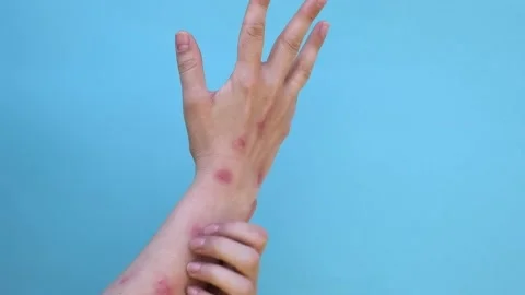 Woman scratches her hands with rash. Pat... | Stock Video | Pond5
