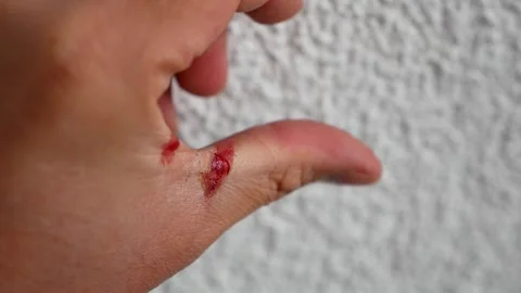 work accident a human hand injured after... | Stock Video | Pond5