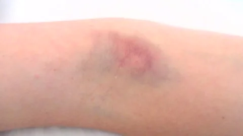 wound in arm by hematoma | Stock Video | Pond5