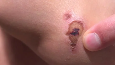 wound, a dried up crust change to scar o... | Stock Video | Pond5