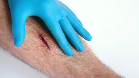 Wound Stock Video Footage | Royalty Free Wound Videos | Pond5