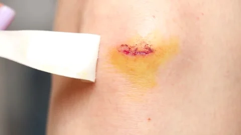 Wound Knee Stock Videos – Royalty-Free HD & 4K Videos