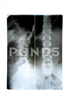 Photograph: X-ray of the back, lumbar spine. 2 views. #141917742