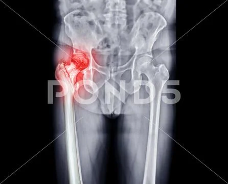 X-ray Both hip ap view showing Right hip replacement or hip prosthesis ...