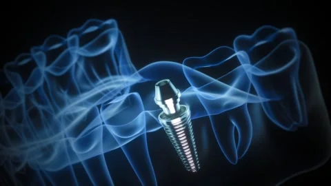 Dental Implant Animation 库存视频影片 | 免版税Dental Implant Animation 视频 | Pond5