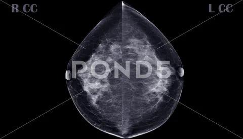 X-ray Digital Mammogram or mammography of both side breast CC view ...