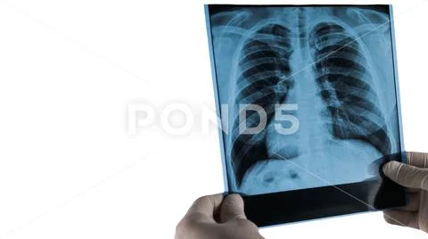 X-ray of the human lungs. Lung x-ray isolated on white background close ...