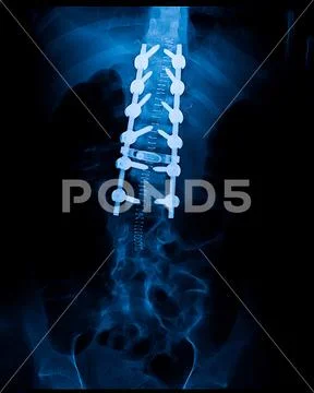 X ray of the human spine fracture. Lumbar spine radiograph using steel ...