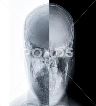 X-ray image of Human Skull town's view for diagnosis skull fracture ...