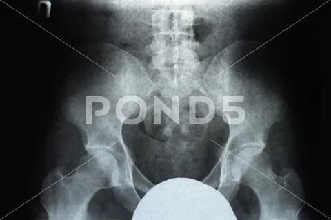 X-ray of the pelvis and sacrum. X-ray ~ Premium Photo #113143734