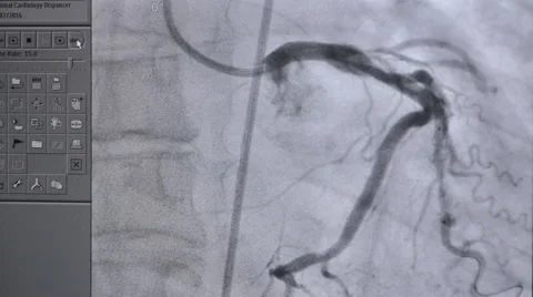 Cardiac Stock Footage ~ Royalty Free Stock Videos | Pond5