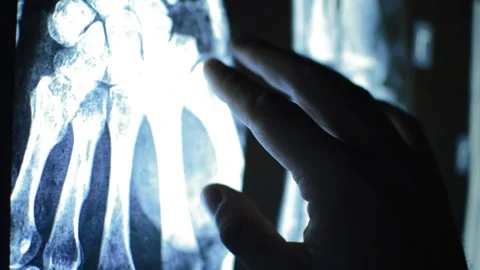 x-ray scan of a broken bone. anatomy inj... | Stock Video | Pond5