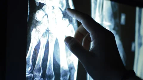 x-ray scan of a broken bone. anatomy inj... | Stock Video | Pond5
