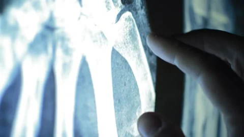 x-ray scan of a broken bone. anatomy inj... | Stock Video | Pond5