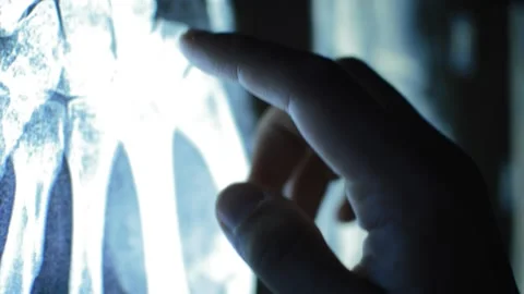 x-ray scan of a broken bone. anatomy inj... | Stock Video | Pond5