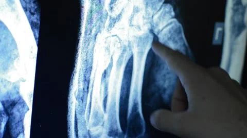 x ray scan of a broken bone in the hospi... | Stock Video | Pond5