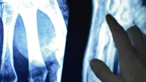 x ray scan of a broken bone in the hospi... | Stock Video | Pond5