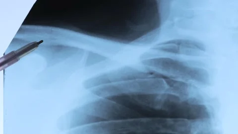 X-ray scan of Dislocation of the acromi... | Stock Video | Pond5
