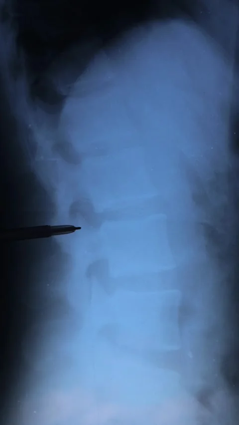 X-ray scan of intervertebral discs in sp... | Stock Video | Pond5