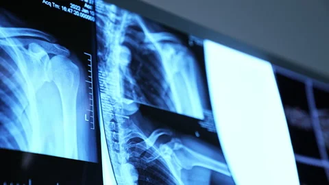 X-ray shots of human chest and shoulder ... | Stock Video | Pond5