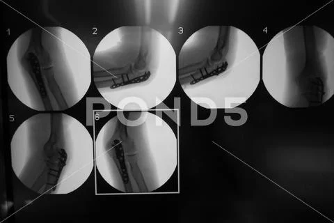 Photograph: X-ray shows a titanium plate that was used to stabilize an ...