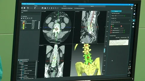 X-ray of the spine on the monitor screen | Stock Video | Pond5