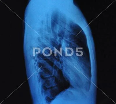 X-Ray X-Ray Image Of Human Chest front view and lateral view Copyright ...
