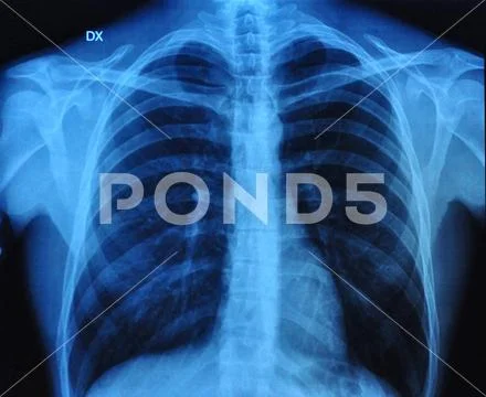 X-Ray X-Ray Image Of Human Chest front view and lateral view Copyright ...