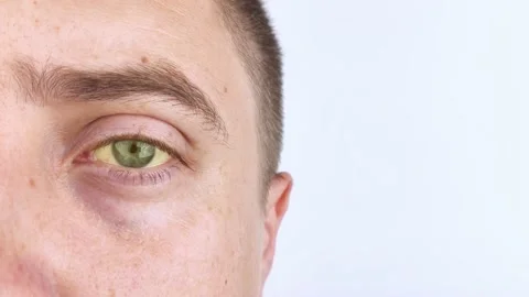 The yellow color of the man eye. Symptom... | Stock Video | Pond5