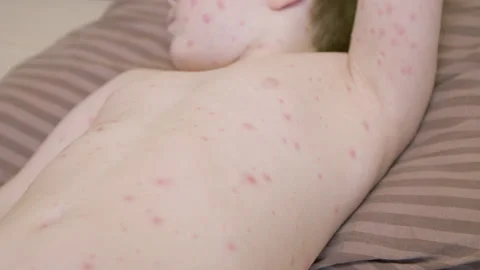 Young child with a skin rash chickenpox ... | Stock Video | Pond5