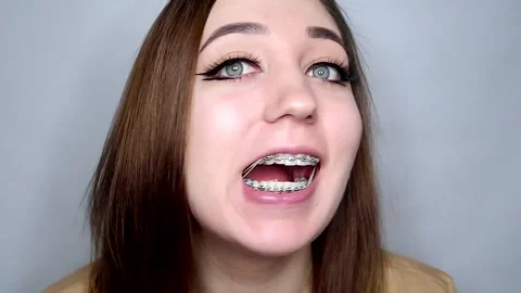 Young lady in braces opens mouth wide, s... | Stock Video | Pond5