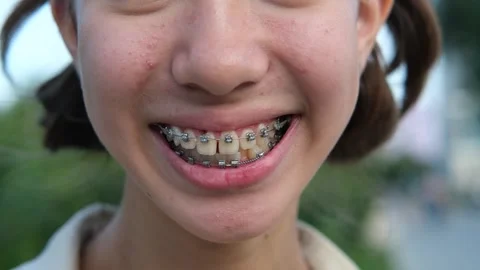 Brace Braces Stock Videos – Royalty-Free HD & 4K Videos | Pond5