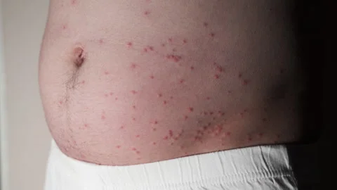 Bumps On Stomach 5 Way To Get Rid Of Lumps After Liposuction Raadina